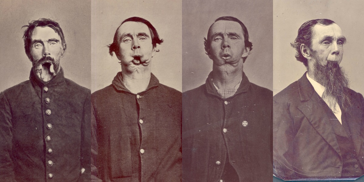 Mending Broken Faces of War- Civil War Medicine - National Museum of ...