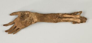 The Story of the Pile of Limbs - Surgeon's Call - National Museum of ...